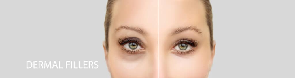 A Comprehensive Guide to Tear Trough Training - Acquisition Aesthetics