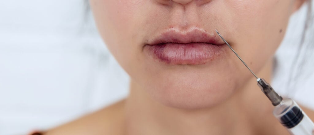 Understanding Bruising with Lip Fillers - Acquisition Aesthetics